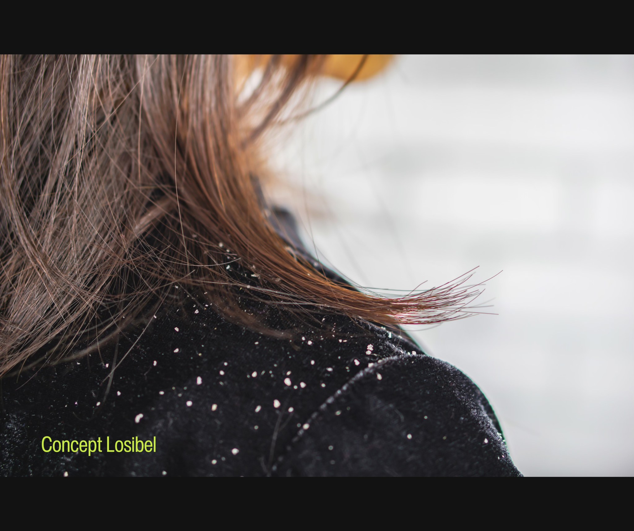 Pellicules grasses : causes, symptômes et solutions